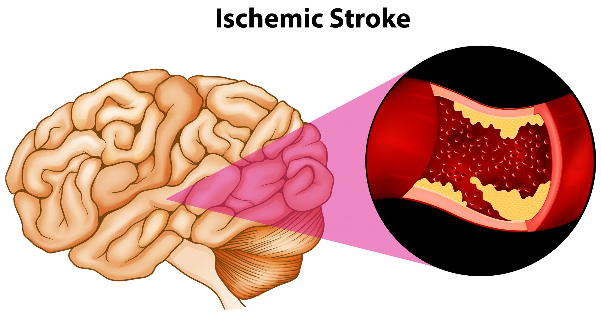 Treatment For Stroke Could PEMF Therapy Be An Accepted Therapy In