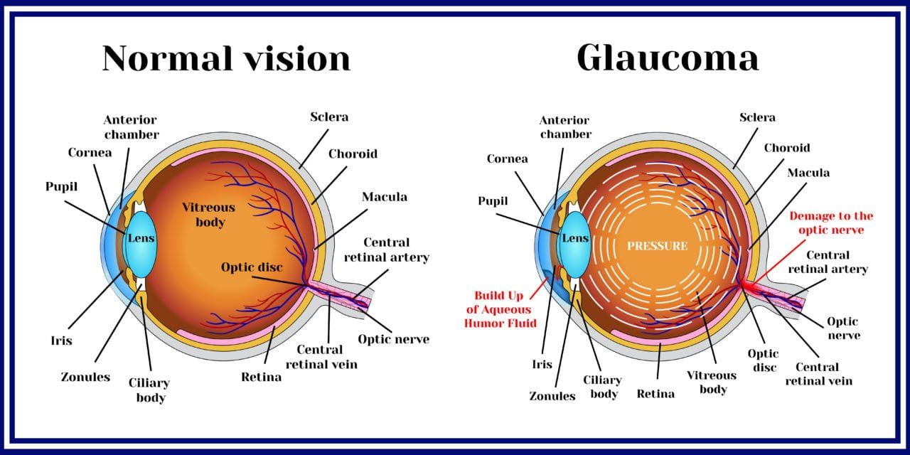 The Effectiveness Of PEMF Therapy For Glaucoma PEMF Therapy Education The Effectiveness Of PEMF Therapy For Glaucoma PEMF Therapy Education